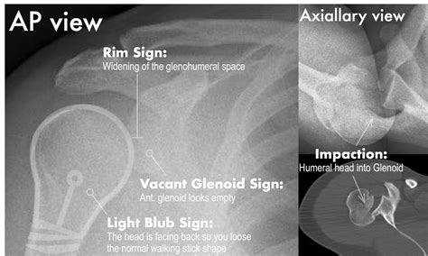 Posterior Shoulder Dislocation Uk