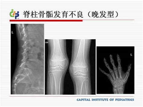儿童跟骨骨骺x线图片 小儿肱骨骨骺线图片 儿童肱骨骨骺正常线 第4页 大山谷图库