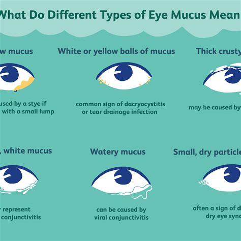 Stringy Eye Discharge