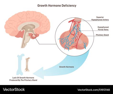 Growth Hormone Deficiency Syndrome Characterized Vector Image