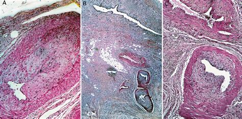 Hematoxylin And Eosinstained Sections Of Biopsy Tissue Obtained From