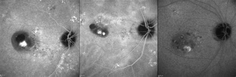 Effects Of Choroidal Vascular Hyperpermeability On Anti Vascular