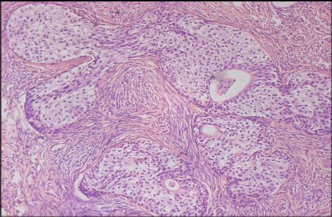 Microphotograph Showing Nests Of Transitional Epithelial Urothelial