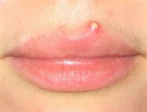 Can You Get A Pimple On Your Lip Med