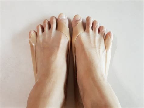 무지외반증 교정기 와이엘슈어 발가락교정기 네이버 블로그