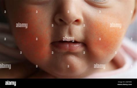 Fifths Disease On Face
