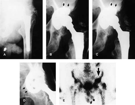Case 5 A Preoperative Left Hip Radiograph With Disassociated Bipolar