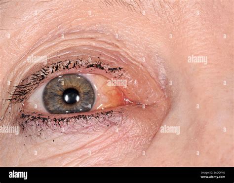 Conjunctival Oedema Due To Allergy In The Eye Of A 57 Year Old Woman