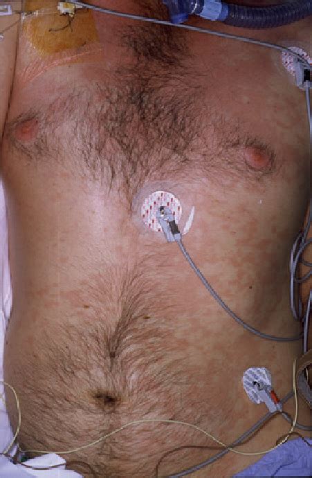 Areas Of Confluent And Patchy Erythema That Developed On The Trunk