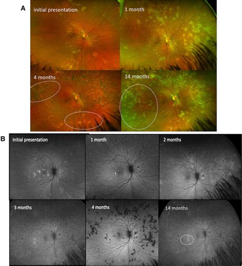 Patient 1 A Ultrawide Field Fundus Color Imaging Over Time Right