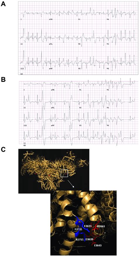 Clinical Characterization Of The Catecholaminergic Polymorphic