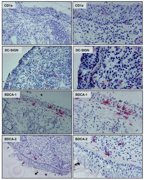Expression Of Dc Sign Cd1a Bdca 1 And Bdca 2 In Nasal Mucosa