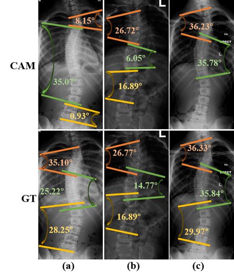A Landmark Aware Network For Automated Cobb Angle Estimation Using X Ray Images AI Research