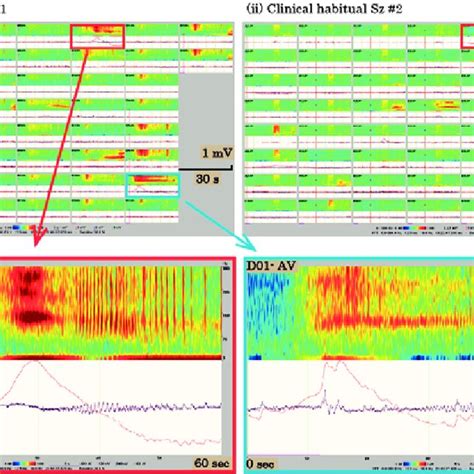 The Scalp Eeg Of Patient B The Red Bar Marks The Onset Of A Seizure