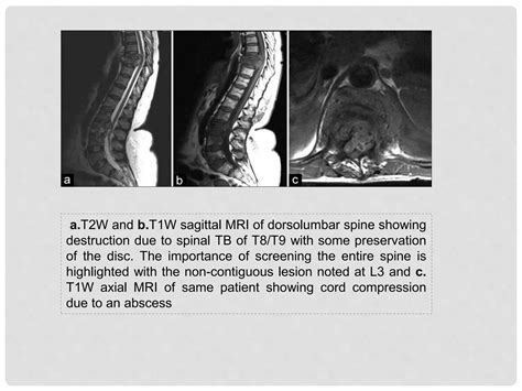 Spinal Infection Ppt