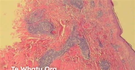 Pathology Of Erythema Annulare Centrifugum Image