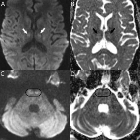 Mri Performed Thirteen Days Postoperatively High B Value Dwi And