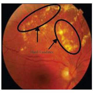 Colored Fundus Image Marked With Important Retinal Features 12