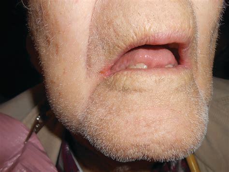 The Multiple Etiologies Of Angular Cheilitis Registered Dental Hygienists