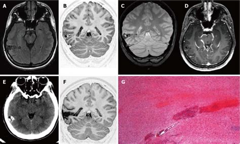 Ganglioglioma World Health Organization Grade I Of The Right Posterior