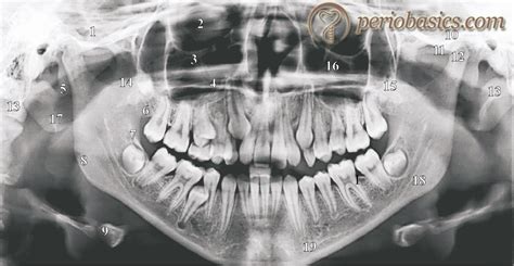 Severe Periodontitis Radiograph