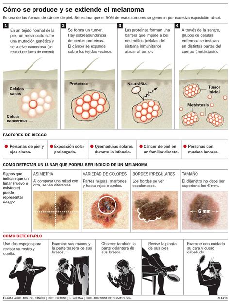 Mira Como Se Hace Cancer De Piel De La Belleza De Un Lunar Al Peligro