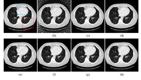 Figure 5 From Convolutional Sparse Coding For Compressed Sensing Ct