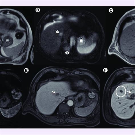 Forty Eight Year Old Woman With History Of Rectal Cancer White Arrow