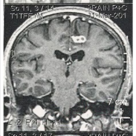Miliary Brain Tuberculosis In A 20 Year Old Female With 3 Month History