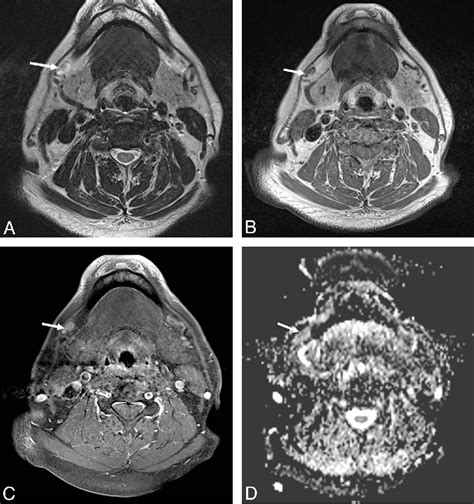 Figure 1 From Neck Cancer Using A 3t Mri Adc Map Prediction Of Nodal