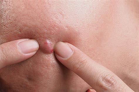 Abscess Incision And Drainage Treatment In Houston Tx Luxe Primary