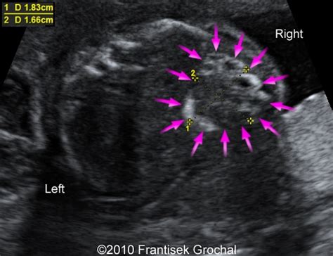 📃 Transient Abdominal Cyst