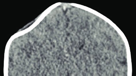 Ct Head Showing The Absence Of Intracranial Bleeding Or Midline Shift