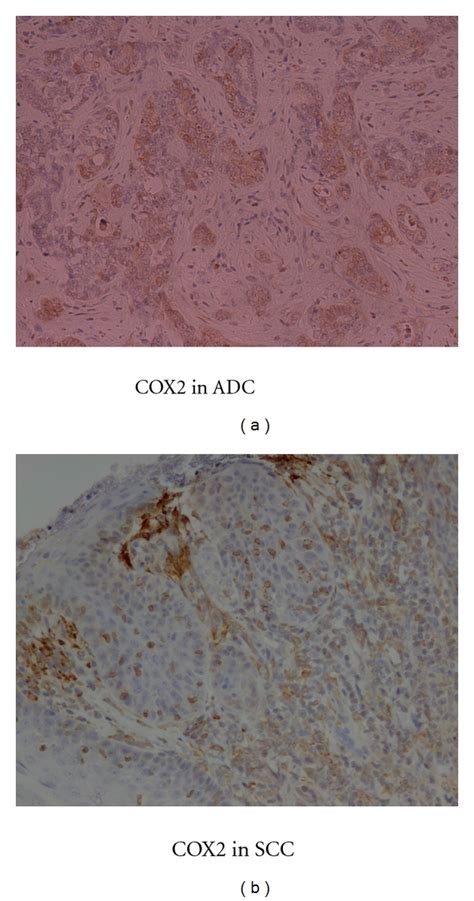 immunohistochemical staining for cox2 in scc and adc download