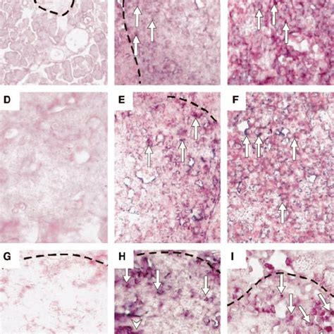 Progression Of Insulitis And Pancreatic ␤ Cell Destruction During