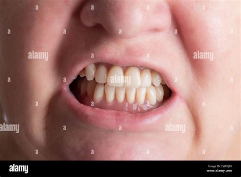 Prosthetics And Orthodontic Treatment A Woman Demonstrates Removable