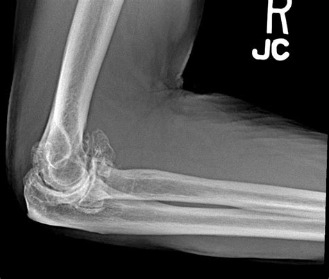 Lateral Elbow Xray Showing Severe Osteoarthritis Wiki Sports Medicine