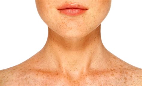 Why We Love Hydroquinone For Hyperpigmentation Dr Sylvia Skincare