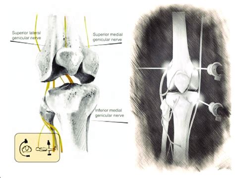 cómo utilizar Pila de alquiler genicular knee block diente tos Para llevar