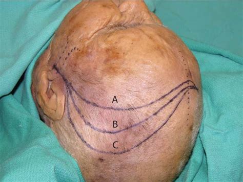 9 Frontotemporal Orbitozygomatic Transcavernous Approach Neupsy Key