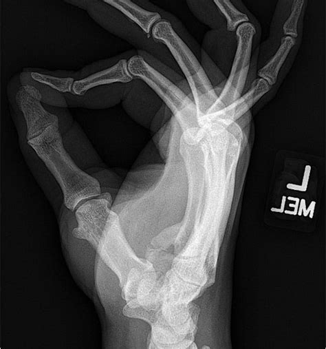 Unique Case Study Post Traumatic Heterotopic Ossification Results In