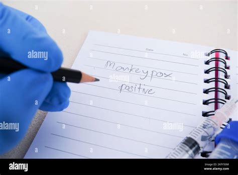 Doctor Hand Writes Monkeypox MPXV Virus Positive Result Into Notepad