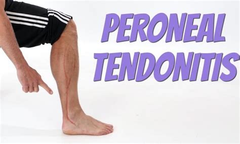 Peroneal Tendonitis Exercises Peroneal Tendonitis Workup And