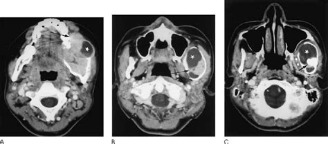 Ameloblastoma Radiology Key