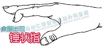 锤状指有哪些症状郑州仁济医院