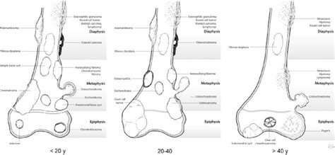 Differential Diagnosis Of Bone Tumors Based On Age And Location