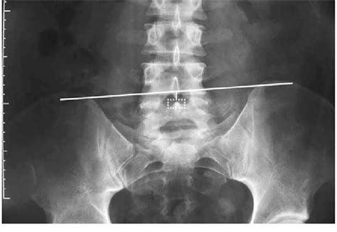 Plain Film Radiograph Antero Posterior View Of The Lumbar Spine Download Scientific Diagram