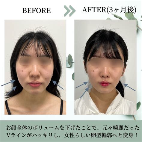 女性らしい理想の卵形へ Sea Clinic −シークリニック 銀座― 理想を叶える小顔治療