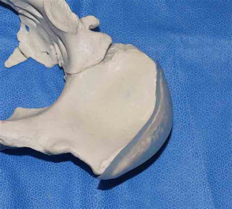 Iliac Crest Implant Oblique View Dr Barry Eppley Indianapolis Explore
