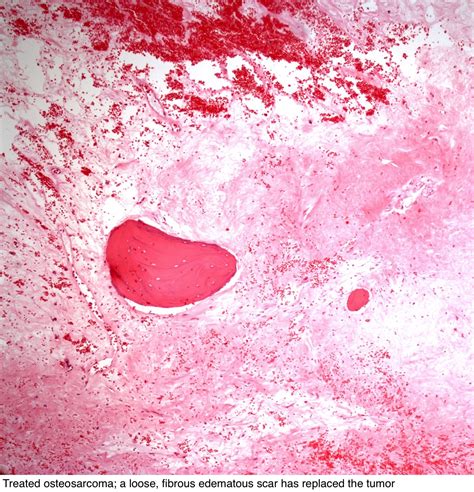 Pathology Outlines Osteosarcoma General